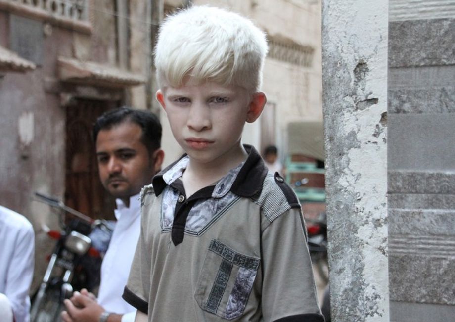 UN Expert Highlights Challenges for Persons With Albinism in Pakistan ...