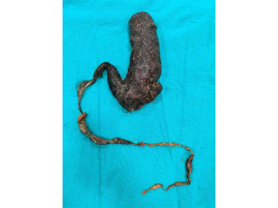 Doctors remove giant hairball from 30-year-old woman suffering months ...